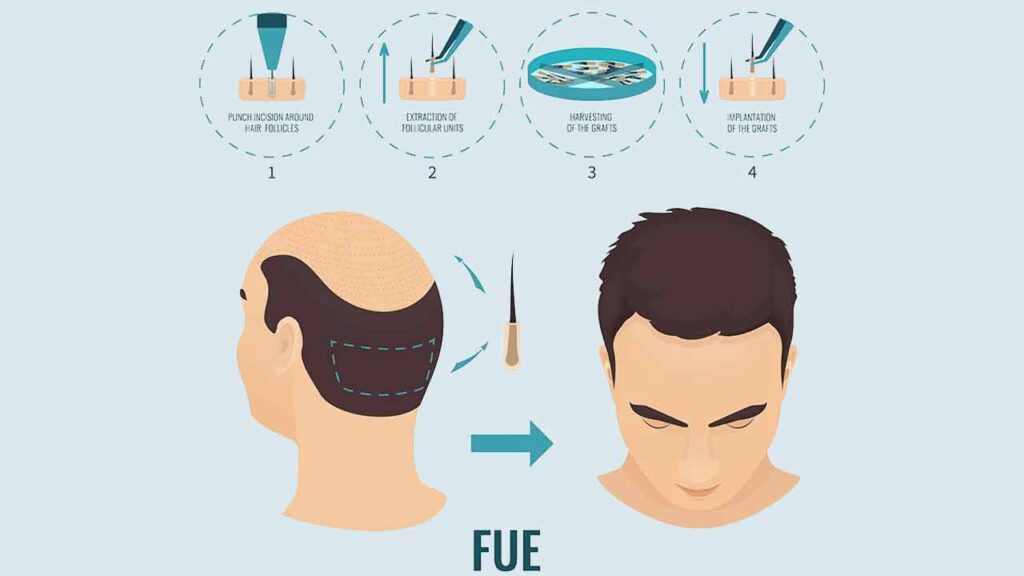 کاشت مو به روش FUE چگونه است؟ فواید این روش + مراقبت های بعد از آن ...